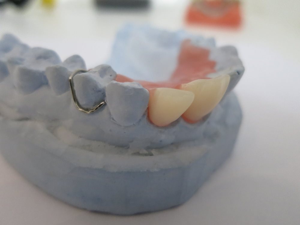 Dentures: Partial, Immediate, Full (Cost Estimate)