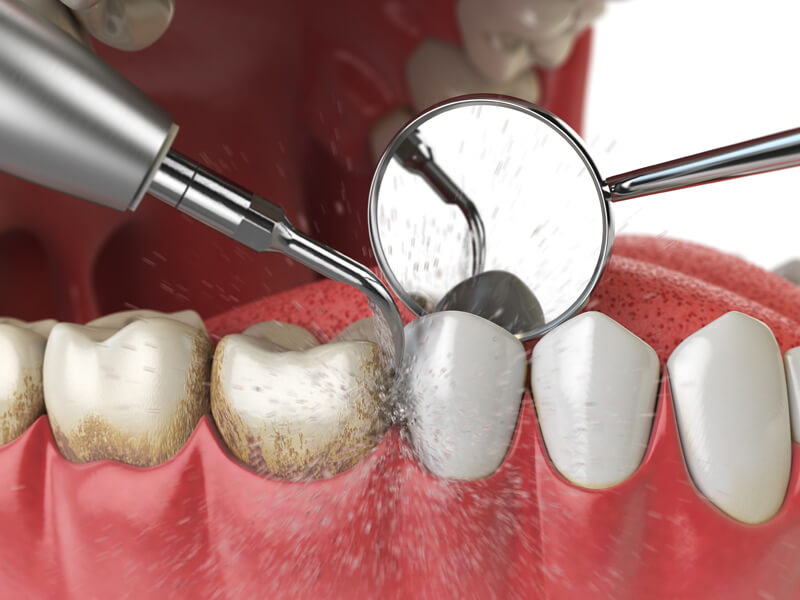 Scaling And Polishing Teeth Cleaning In Singapore Gentle 